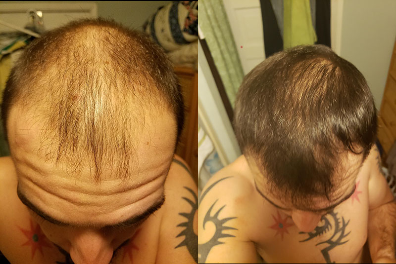 Morr F Topical Solution For Hairloss 5 10 Or 3 Morr F Topical Morr F Topical Solution For Hairloss 5 10 Or 3 Morr F Topical